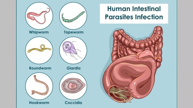 Intestinal Worms: How Do You Know If You Have Parasites?